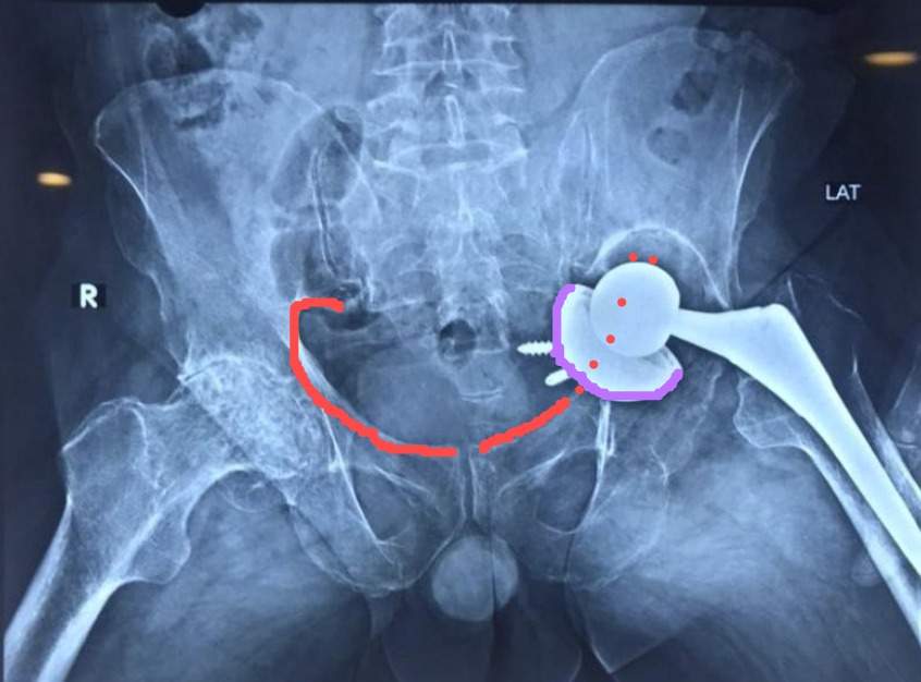 Total Hip Replacement | First Case Revision Hip Catagory